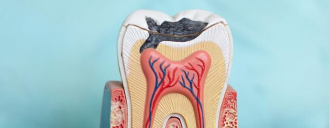 Kako nastaje zubni karijes - Smile Design Kovač