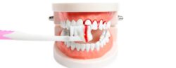 Krvarenje desni tijekom pranja zubi - Smile Design Kovač
